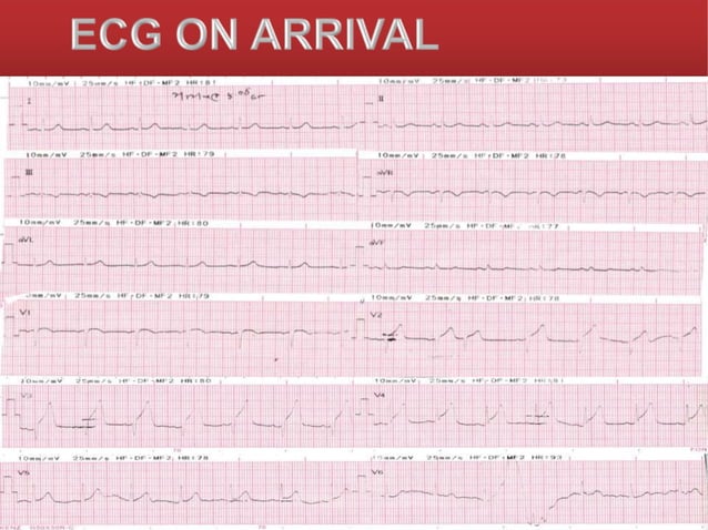 CLINICAL CASE PRESENTATION - STEMI.pptx
