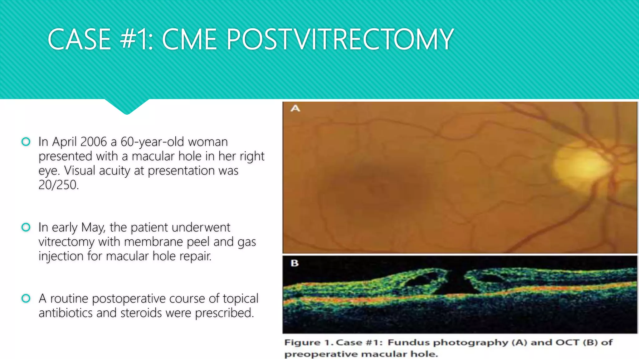 Clinical cases - Cystoid Macular edema | PPTX