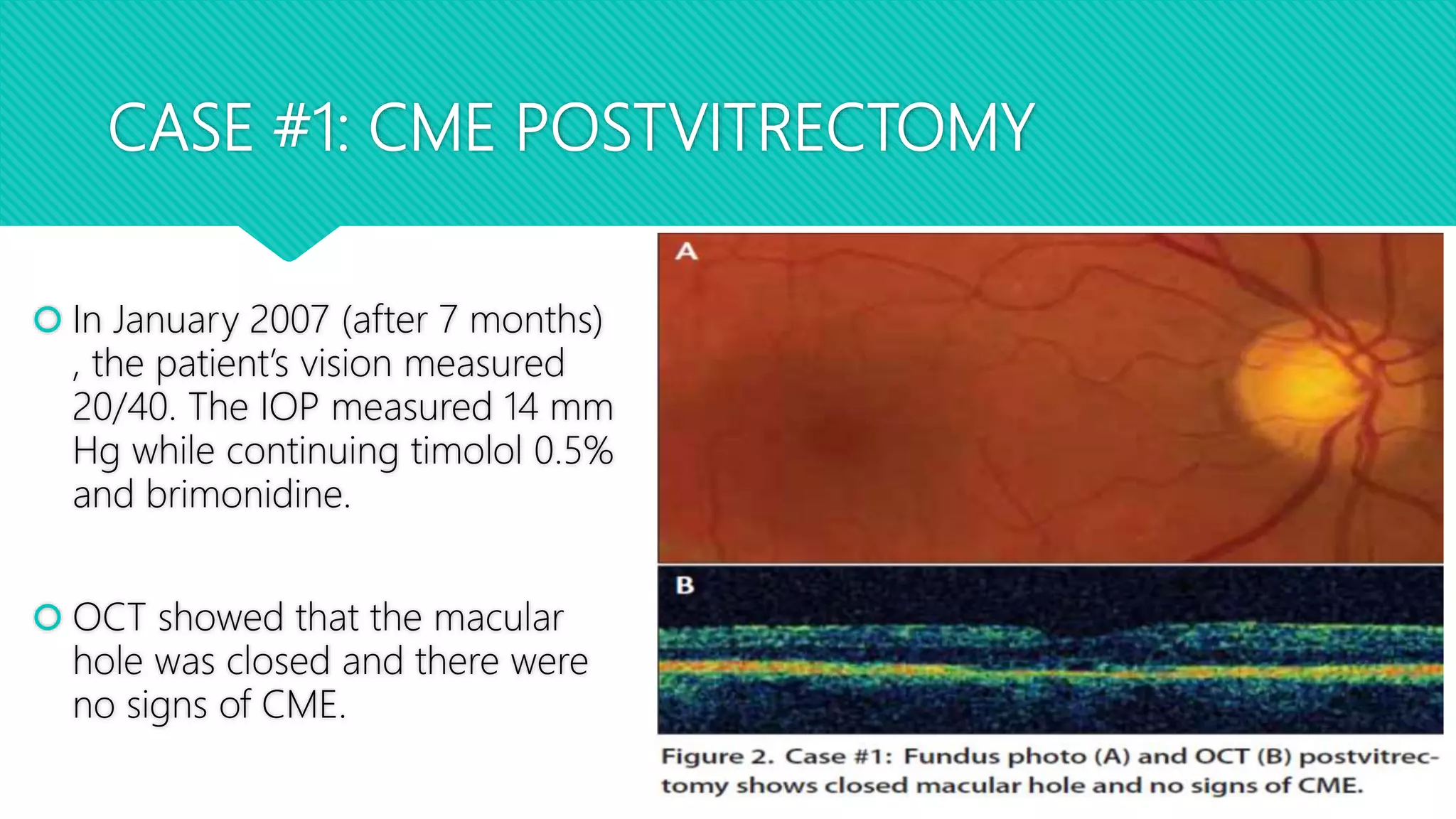 Clinical cases - Cystoid Macular edema | PPTX