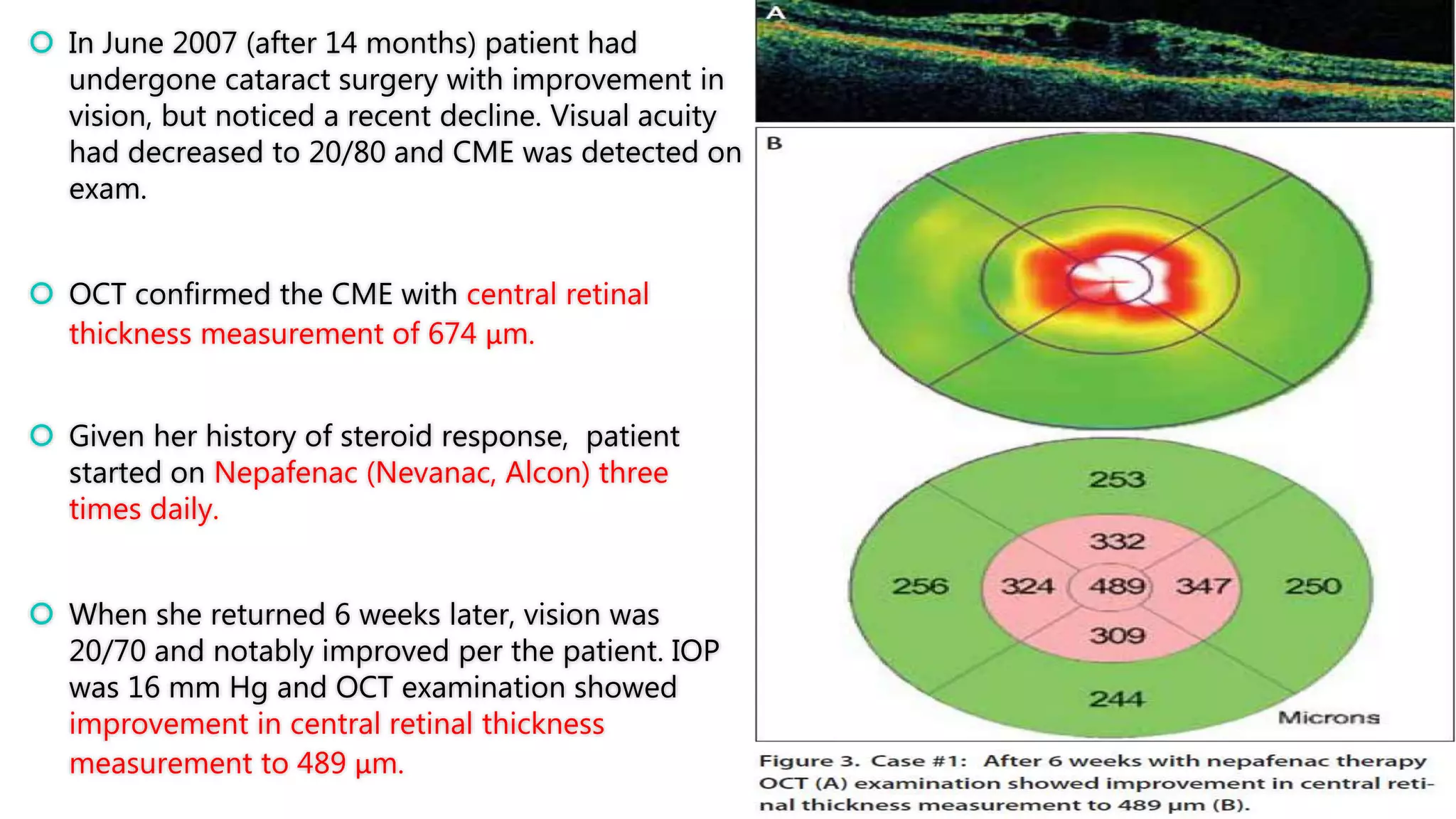 Clinical cases - Cystoid Macular edema | PPTX