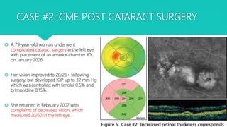 Clinical cases - Cystoid Macular edema | PPTX