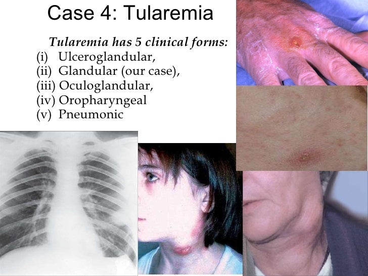 Pneumonic Tularemia The Causes And Complications From Tularemia | CCCH