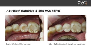 One Visit Crown Clinical Case Photos | PPT