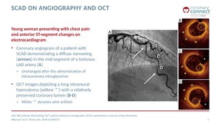 Clinical Case Studies Presenting as Acute Coronary Syndrome.pptx