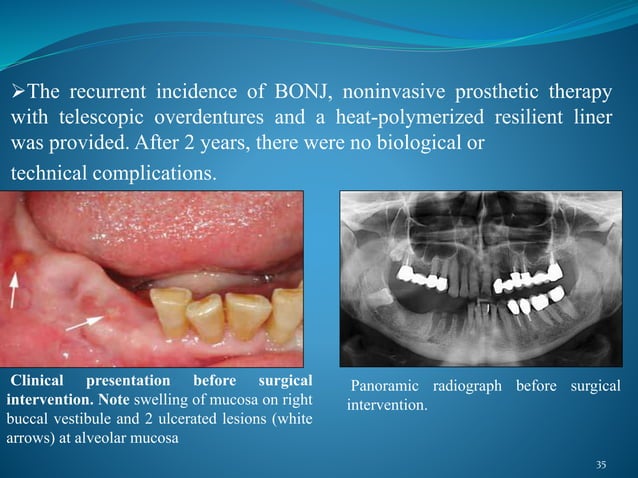 Clinical characteristics of an allergic reaction to a polyether dental ...