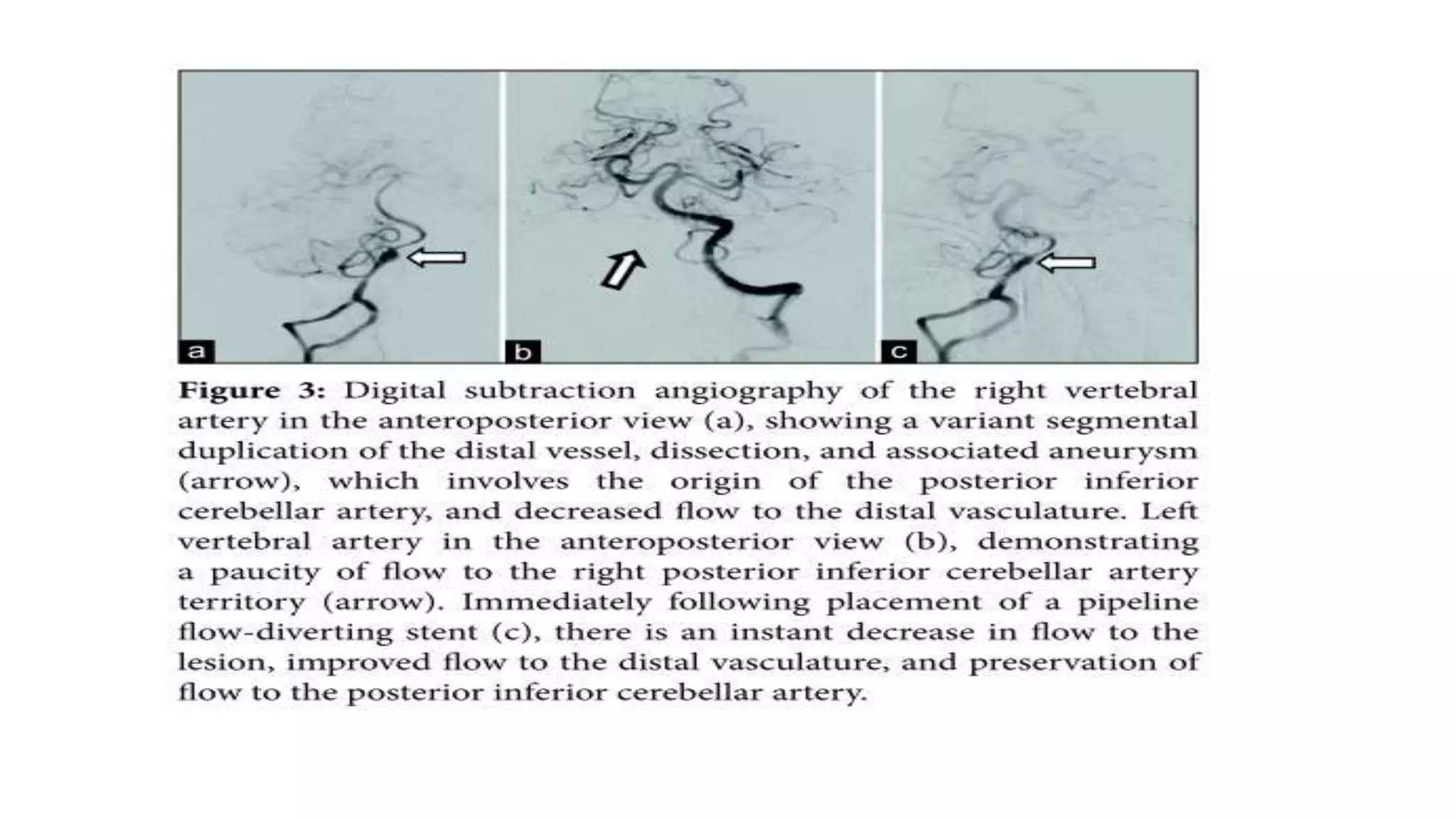 Clinical characteristics of symptomatic vertebral artery dissection | PPT