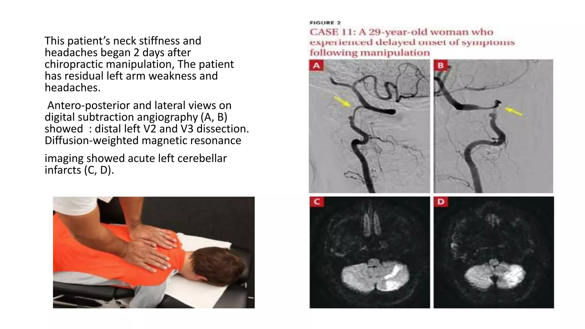 Clinical characteristics of symptomatic vertebral artery dissection | PPT