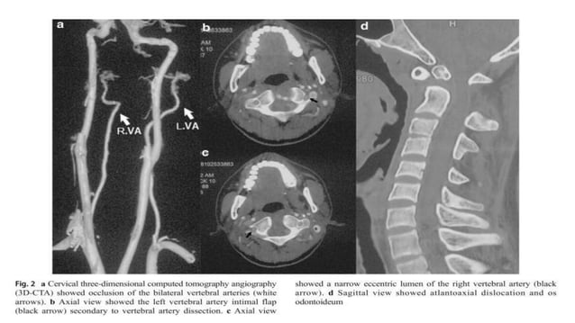 Clinical characteristics of symptomatic vertebral artery dissection | PPT