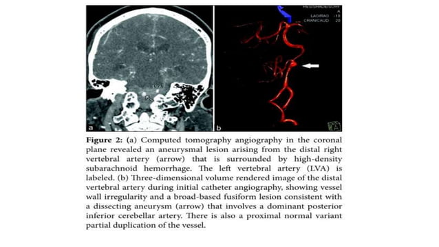 Clinical characteristics of symptomatic vertebral artery dissection | PPT