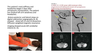 Clinical characteristics of symptomatic vertebral artery dissection | PPT