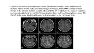 Clinical characteristics of symptomatic vertebral artery dissection | PPT