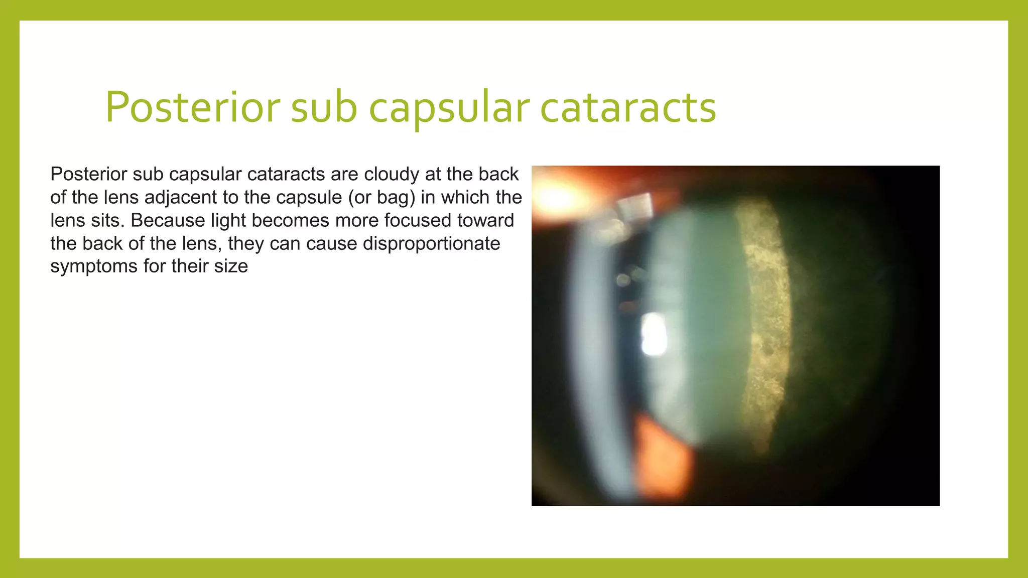 Clinical classification of cataracts : Mehedi , Jr. Optometrist | PPTX