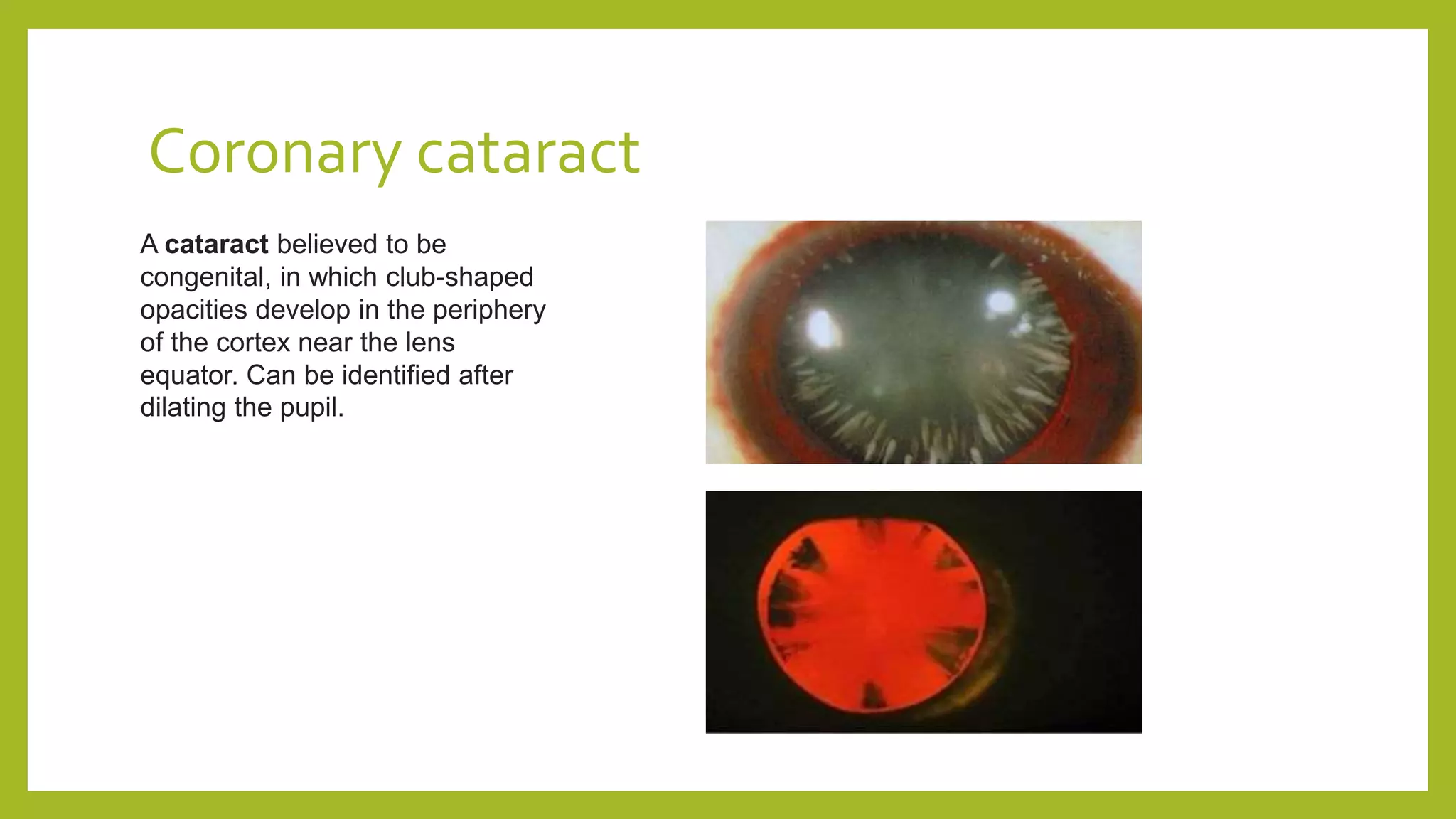 Clinical classification of cataracts : Mehedi , Jr. Optometrist | PPTX