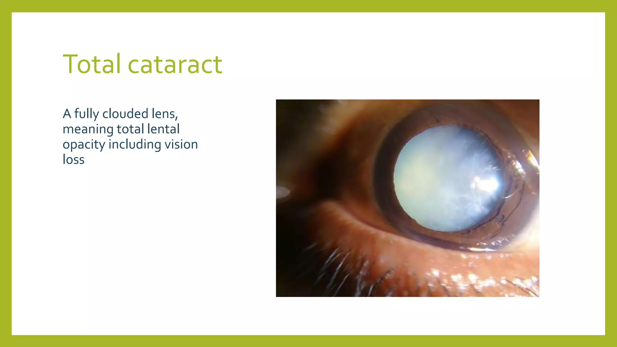 Clinical classification of cataracts : Mehedi , Jr. Optometrist | PPTX