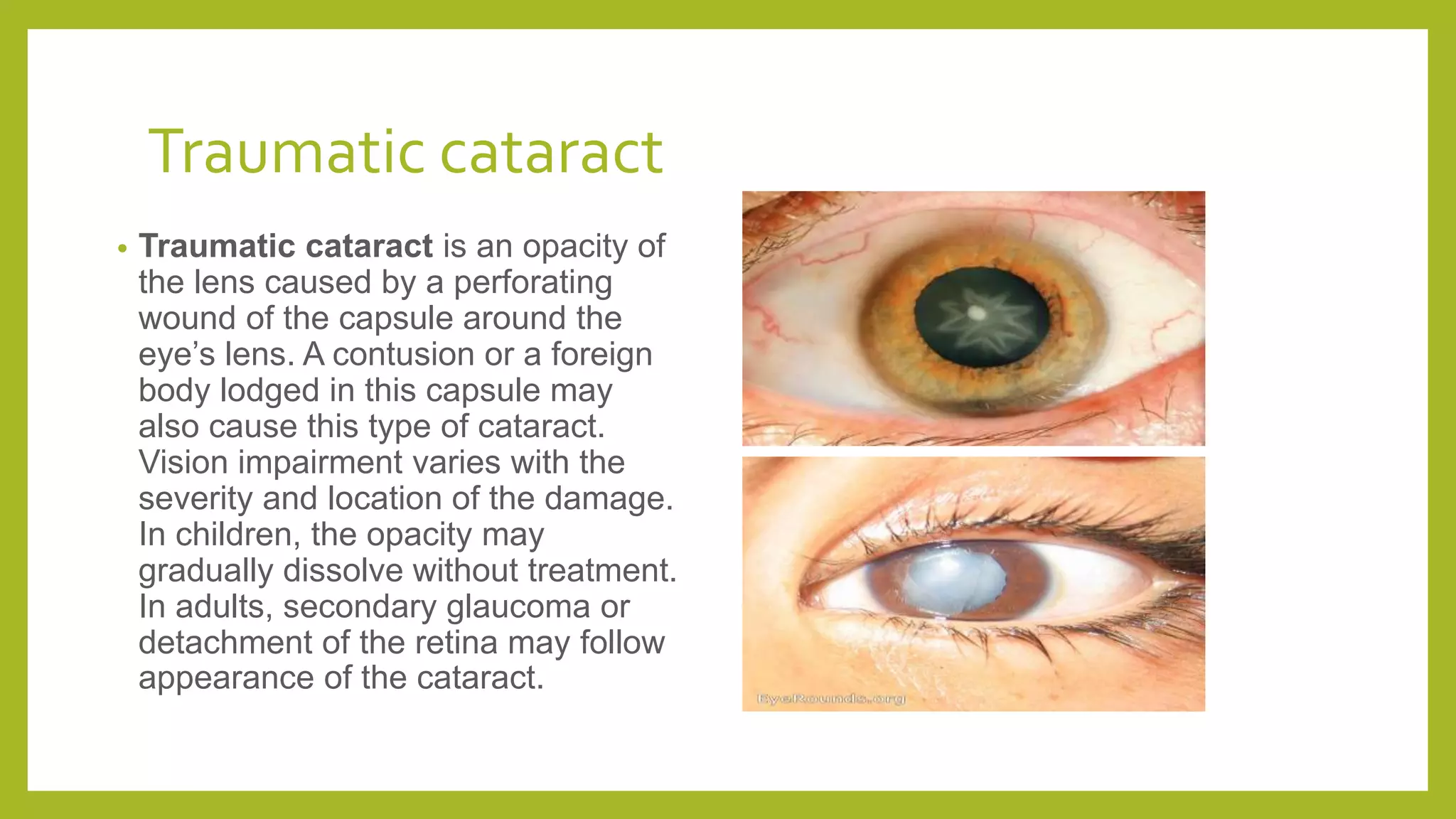 Clinical classification of cataracts : Mehedi , Jr. Optometrist | PPTX