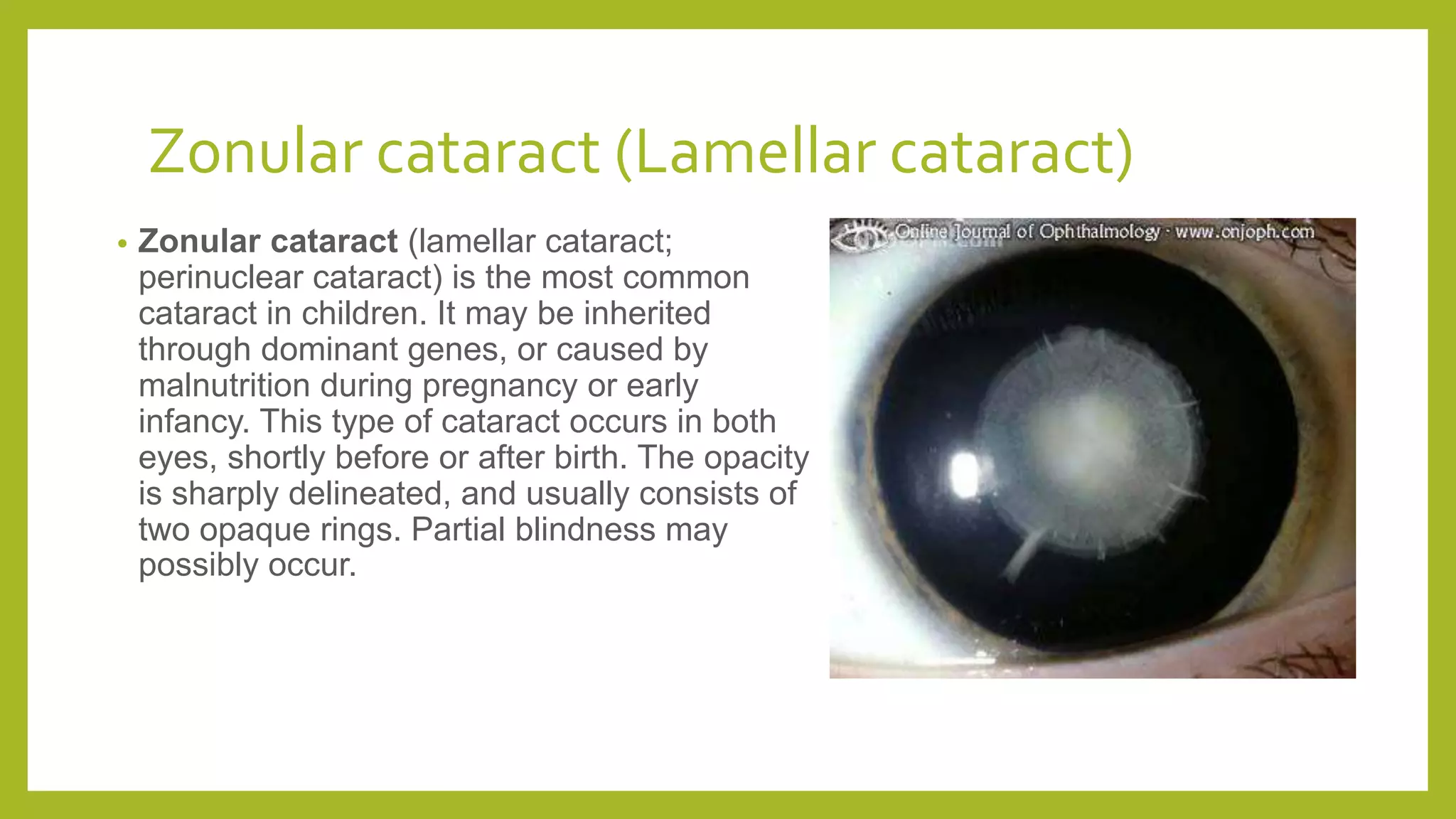 Clinical classification of cataracts : Mehedi , Jr. Optometrist | PPTX