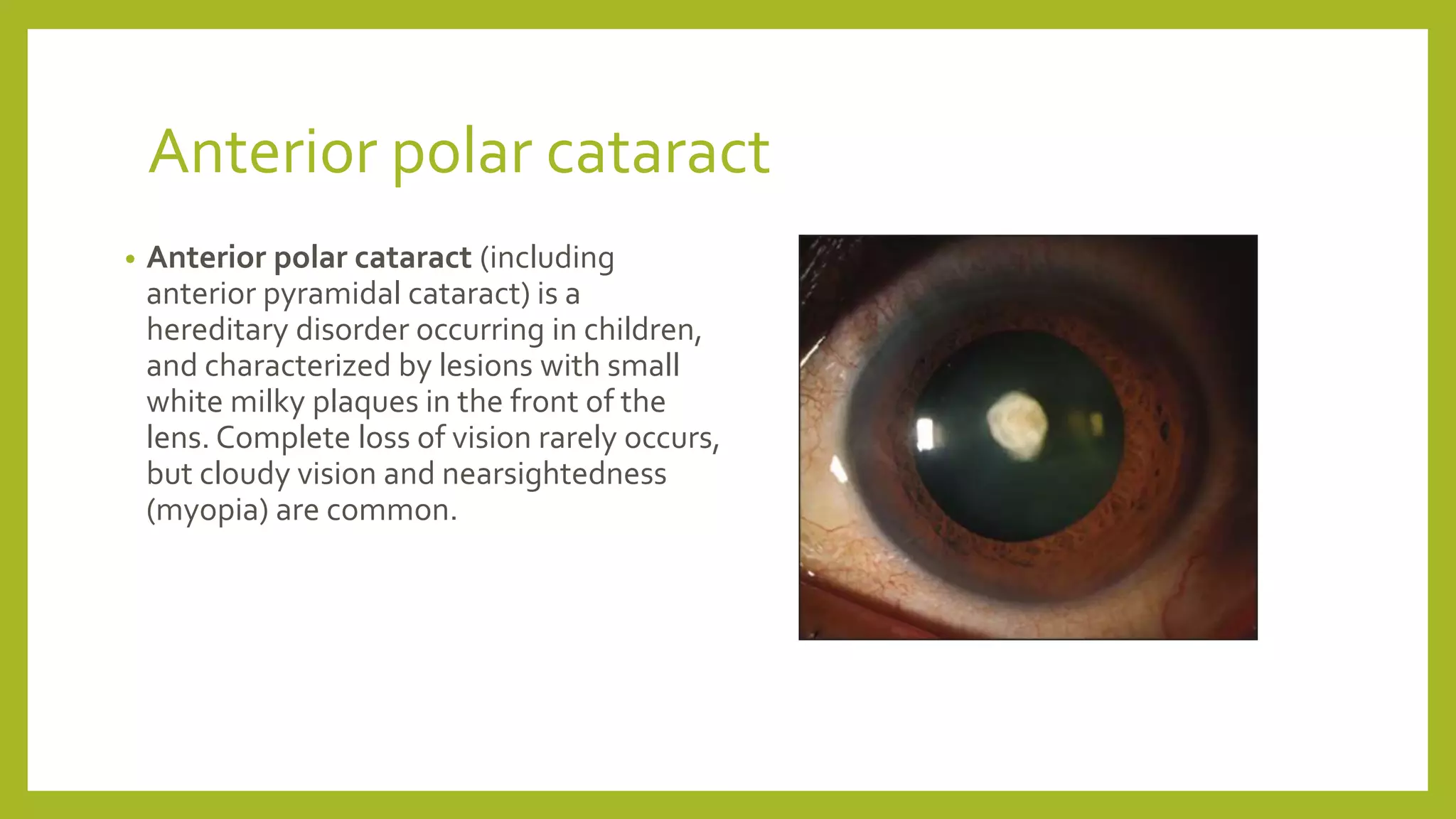 Clinical classification of cataracts : Mehedi , Jr. Optometrist | PPTX