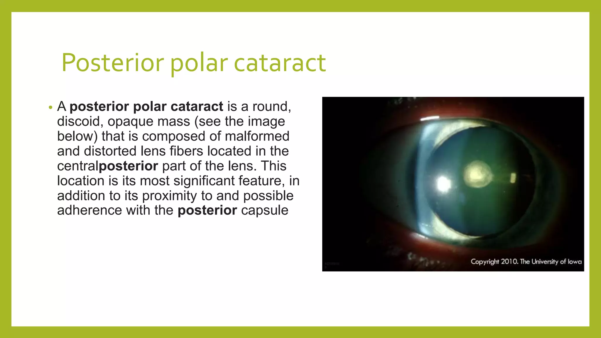 Clinical classification of cataracts : Mehedi , Jr. Optometrist | PPTX