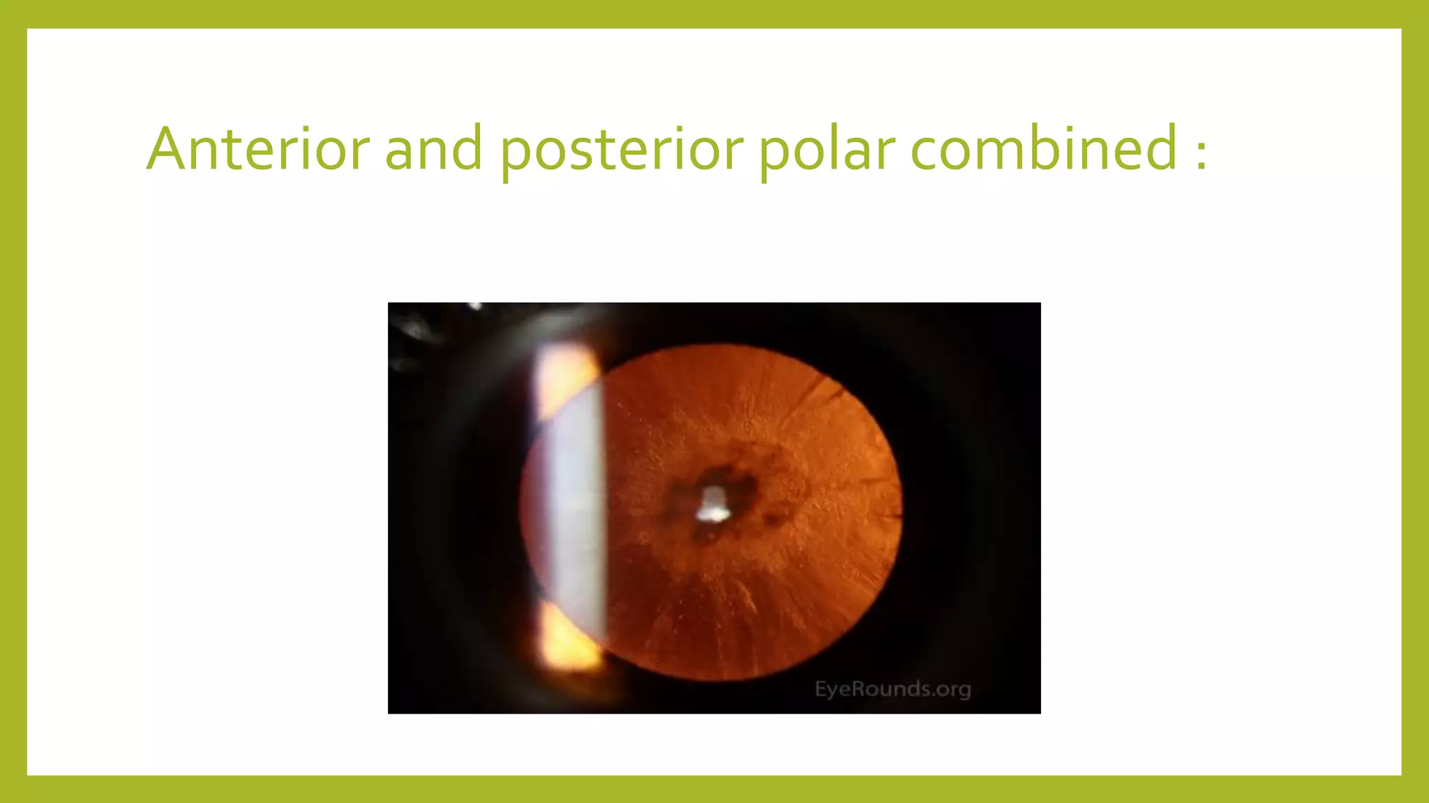 Clinical classification of cataracts : Mehedi , Jr. Optometrist | PPTX