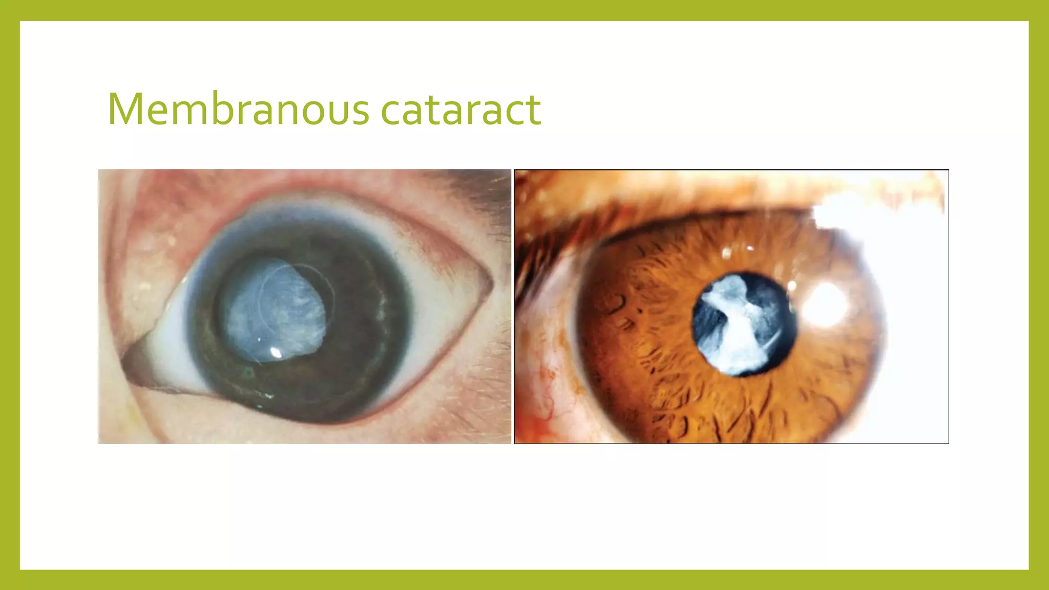 Clinical classification of cataracts : Mehedi , Jr. Optometrist | PPTX