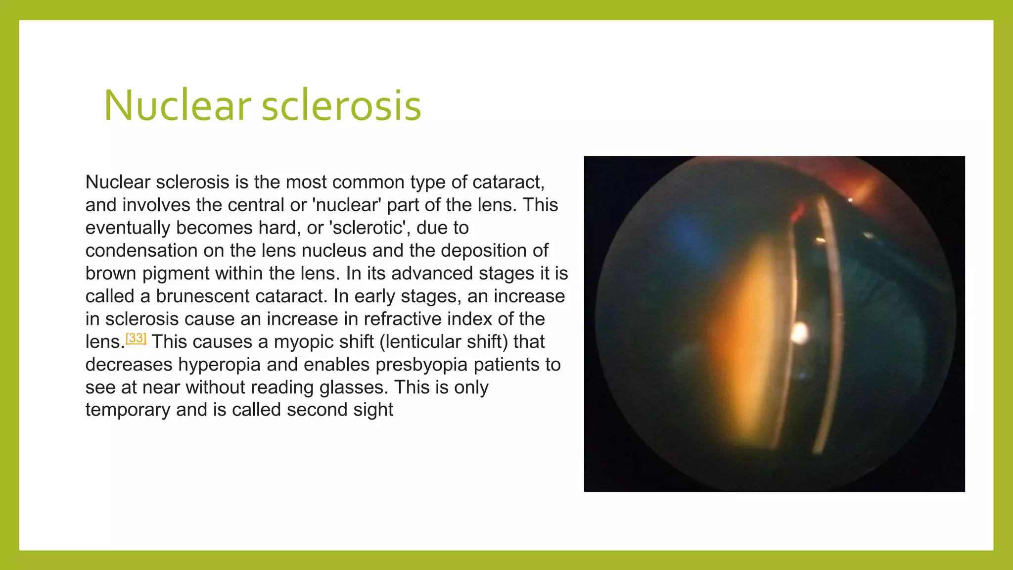 Clinical classification of cataracts : Mehedi , Jr. Optometrist | PPTX