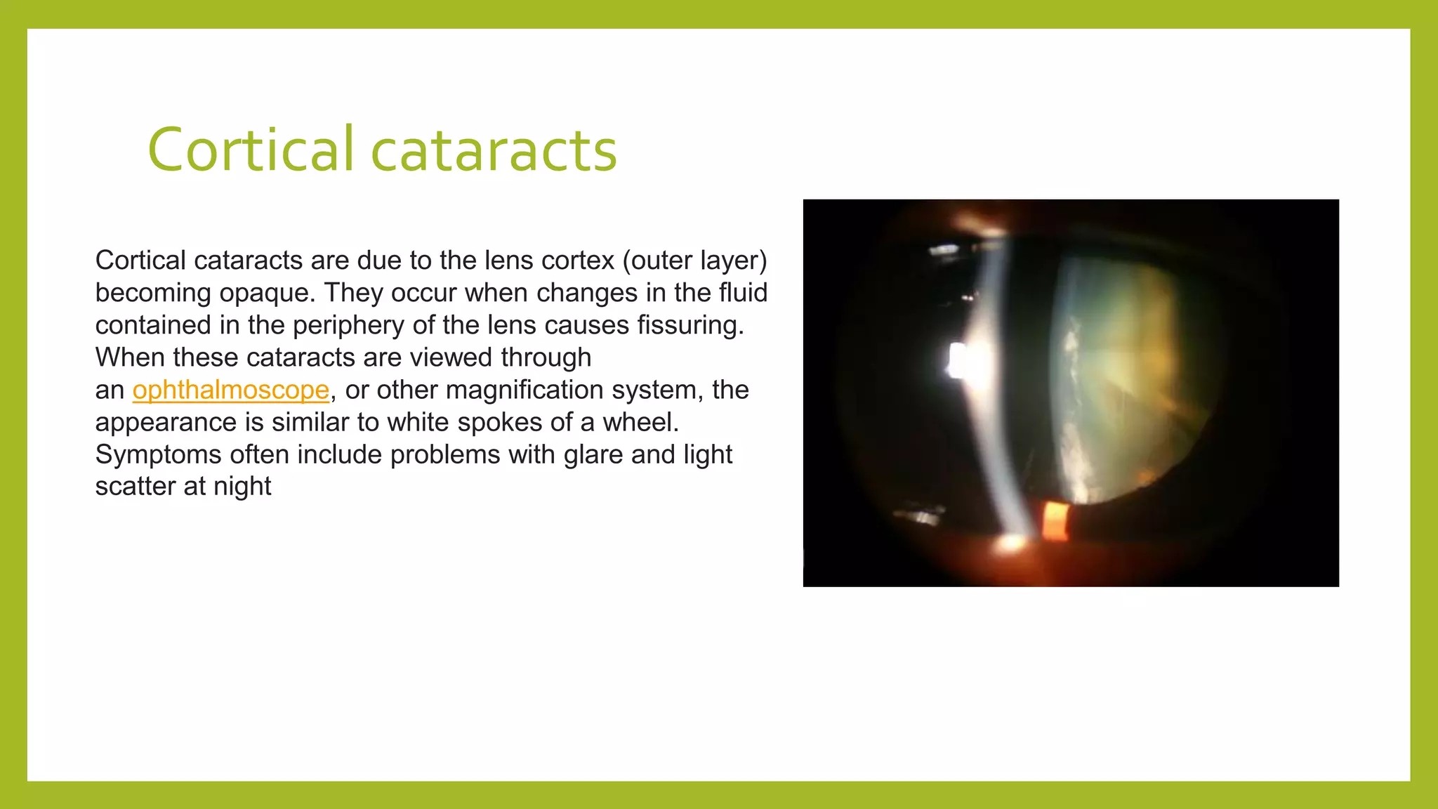 Clinical classification of cataracts : Mehedi , Jr. Optometrist | PPTX