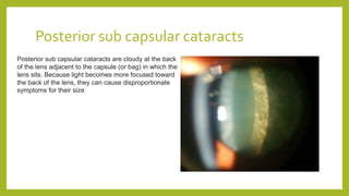 Clinical classification of cataracts : Mehedi , Jr. Optometrist | PPTX