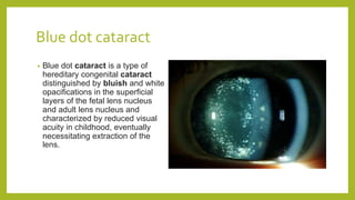 Clinical classification of cataracts : Mehedi , Jr. Optometrist | PPTX