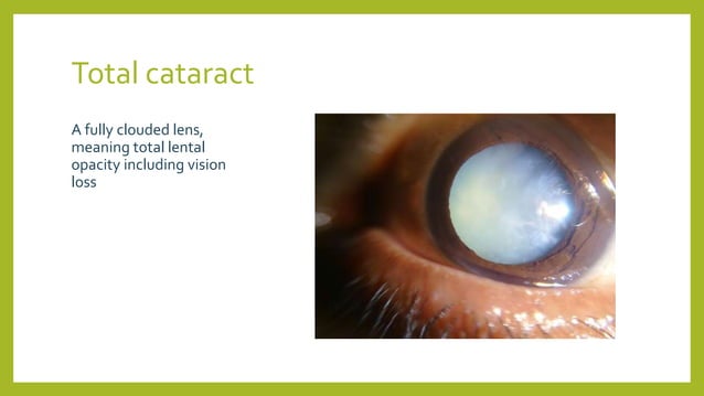 Clinical classification of cataracts : Mehedi , Jr. Optometrist | PPTX