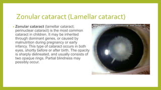 Clinical classification of cataracts : Mehedi , Jr. Optometrist | PPTX