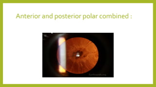 Clinical classification of cataracts : Mehedi , Jr. Optometrist | PPTX