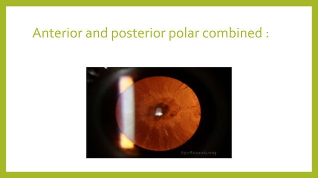 Clinical classification of cataracts : Mehedi , Jr. Optometrist | PPTX