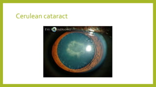Clinical classification of cataracts : Mehedi , Jr. Optometrist | PPTX