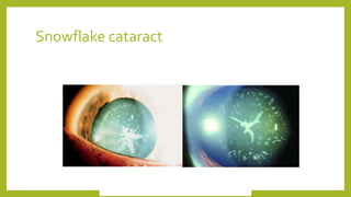 Clinical classification of cataracts : Mehedi , Jr. Optometrist | PPTX