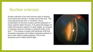 Clinical classification of cataracts : Mehedi , Jr. Optometrist | PPTX
