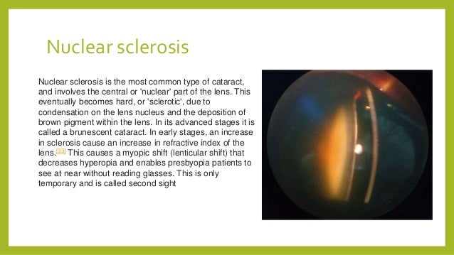 Clinical classification of cataracts : Mehedi , Jr. Optometrist