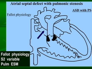 A good ppt on Clinical congenital heart disease for Post Graduate | PPT