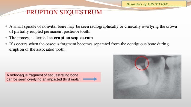 Clinical consideration in tooth development, eruption and shedding