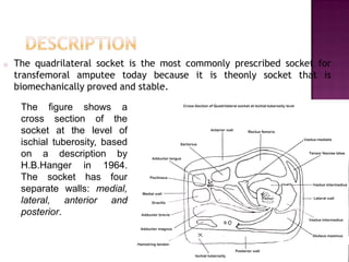Clinical consideration of quadrilateral socket 2000 | PDF
