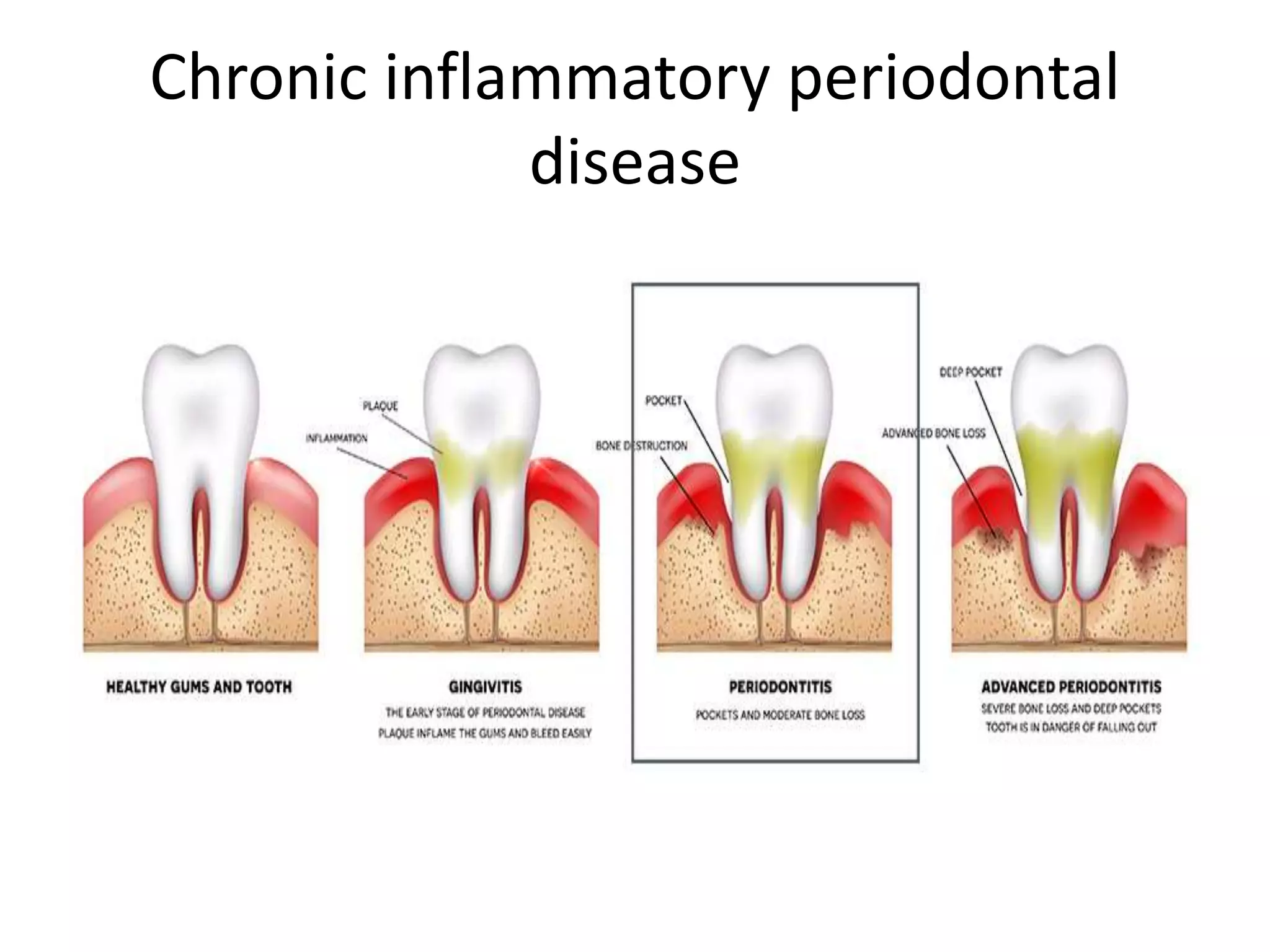 Clinical considerations of periodontal ligament | PPTX