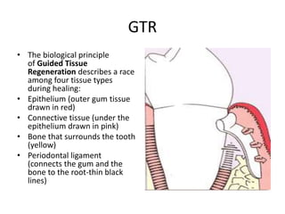 Clinical considerations of periodontal ligament | PPTX