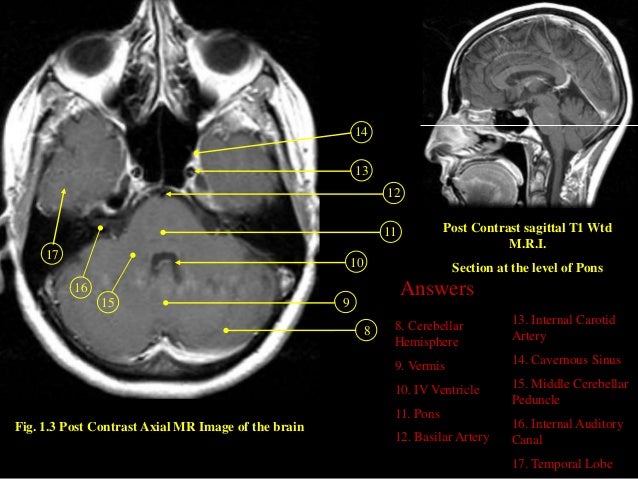 Clinical correlation and interpretation of Brain MRI by dr.Sagor