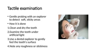 clinical diagnosis and histological presentation of dental caries (1).pptx