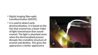clinical diagnosis and histological presentation of dental caries (1).pptx
