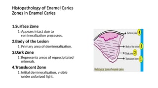 clinical diagnosis and histological presentation of dental caries (1).pptx