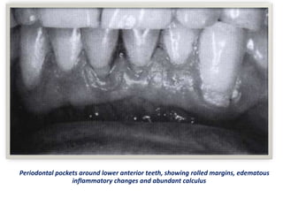 Clinical diagnosis in periodontology | PPTX