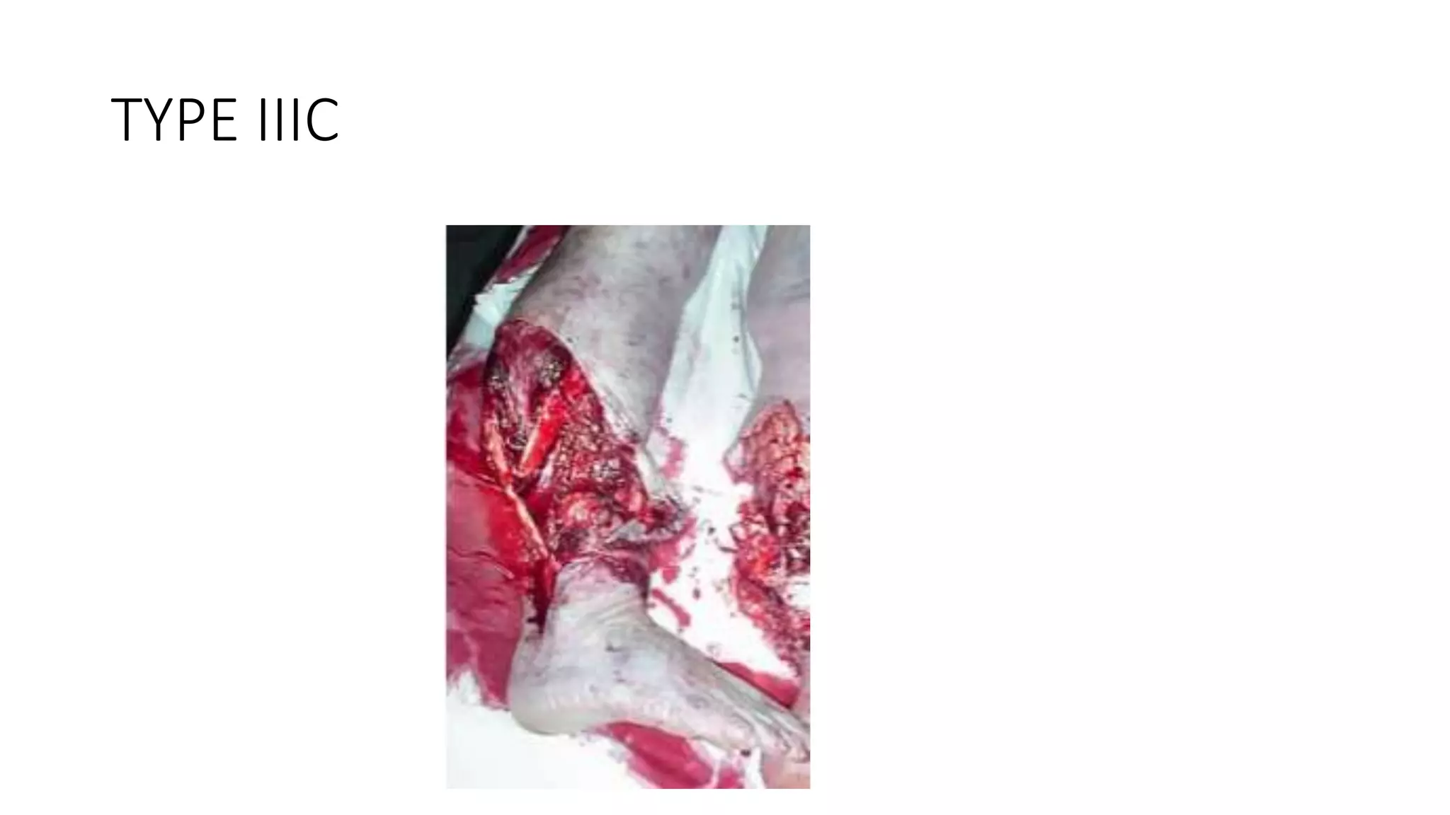 CLINICAL DIAGNOSIS OF FRACTURE AND GENERAL PRINCIPLE OF MANAGEMENT OF ...