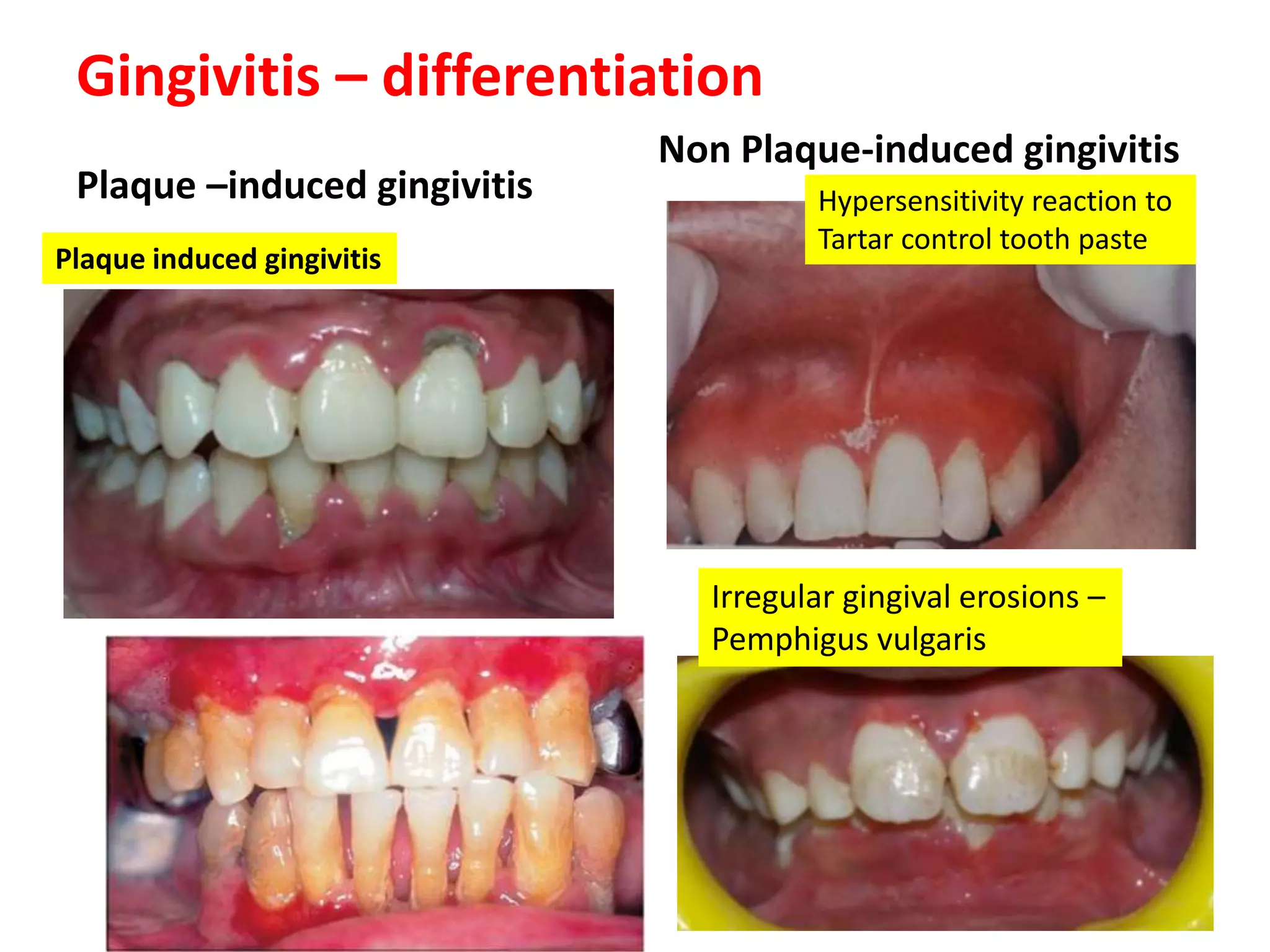 Clinical diagnosis of periodontal diseases | PPTX