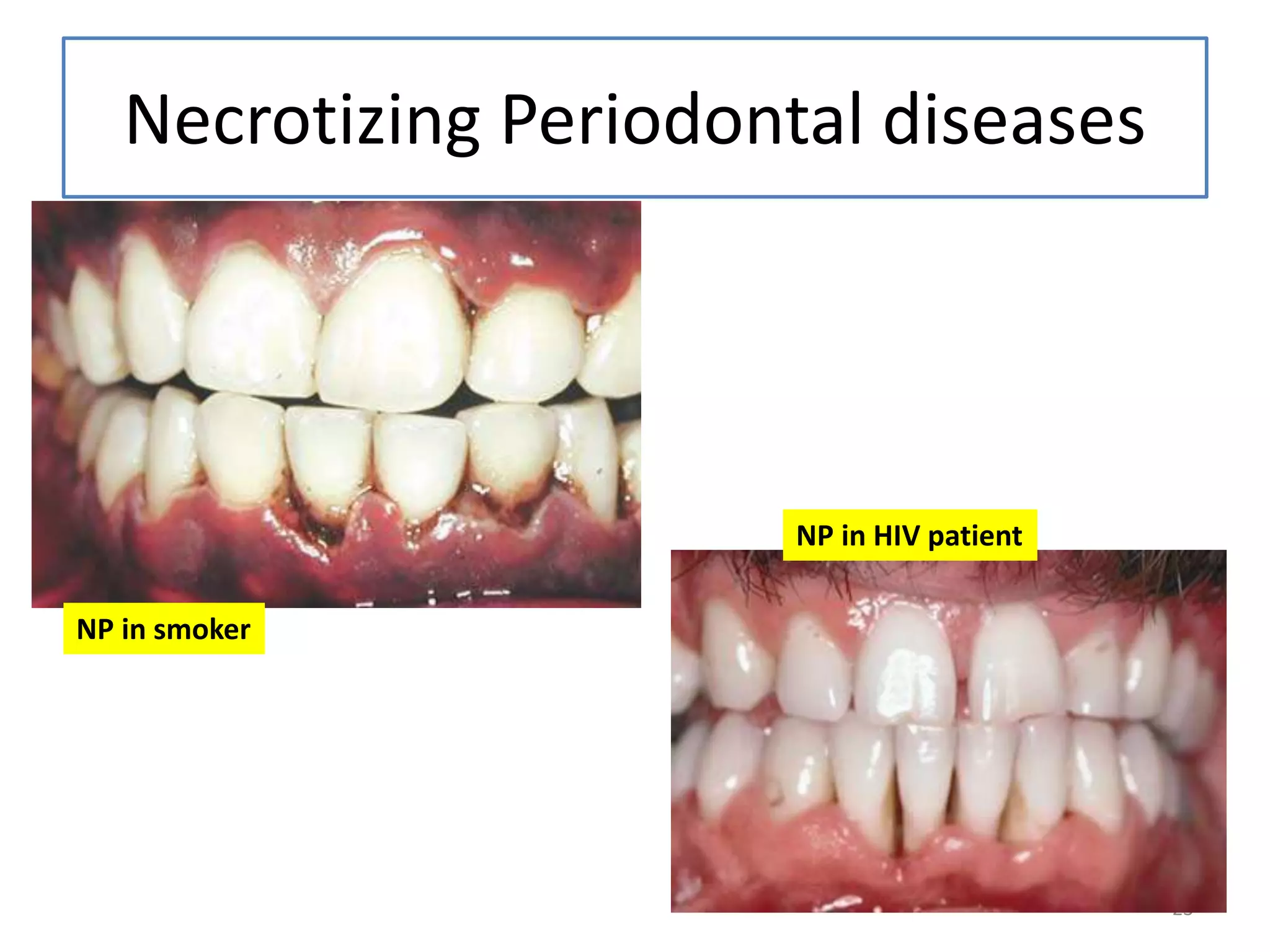 Clinical diagnosis of periodontal diseases | PPTX