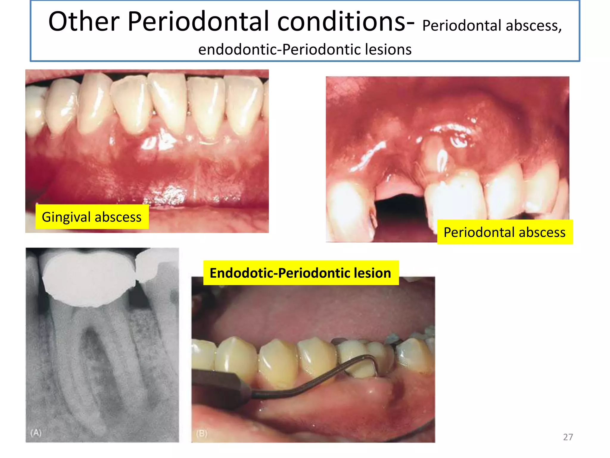 Clinical diagnosis of periodontal diseases | PPTX